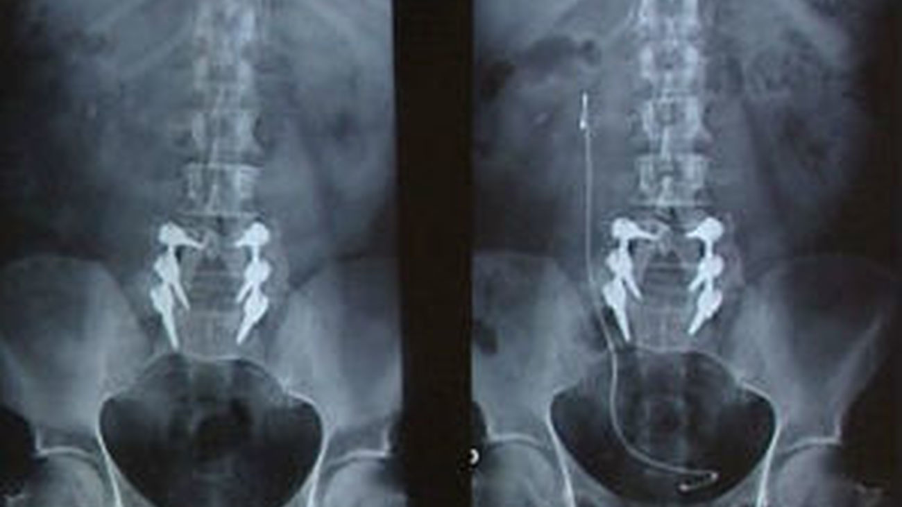 La litotripsia, alternativa a la cirugía que permite tratar el 80% de ...